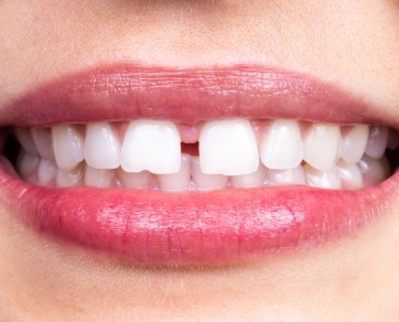 Invisalign Fort Worth, TX | SureSmile Clear Aligners | Orthodontics